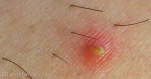 Ingrown Hair: Causes, Symptoms & Treatment