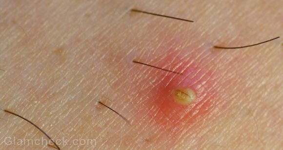 Ingrown Hair: Causes, Symptoms & Treatment
